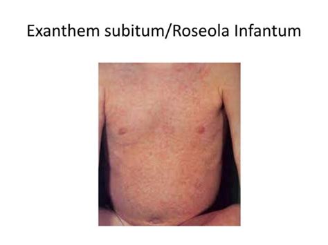 Approach To Common Pediatric Rashes Pptx