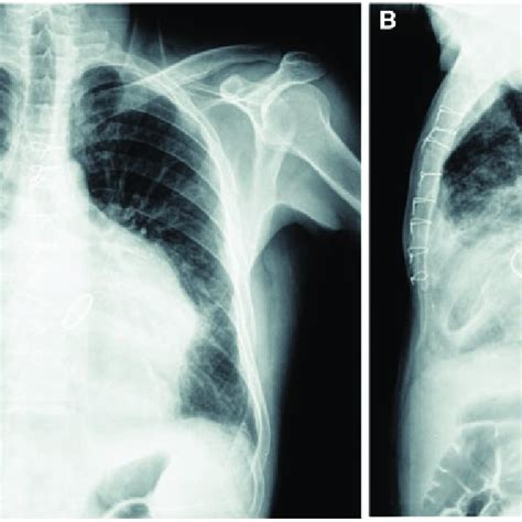 Chest X Ray Showing Marked Cardiomegaly Signs Of Pulmonary Congestion