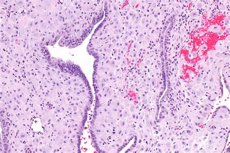 Decidualized Endometrium Libre Pathology