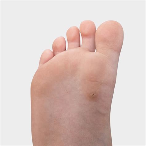 Plantar Wart Verruca Removal Treatment London Wart Clinic