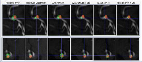 Figure 2 From Weakly Supervised Segmentation Of Intracranial Aneurysms