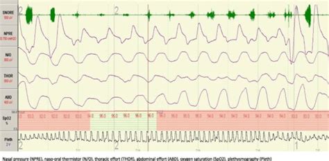 Apnea Hypopnea And Sleep Fragmentation Optimal Sleep Airway Health