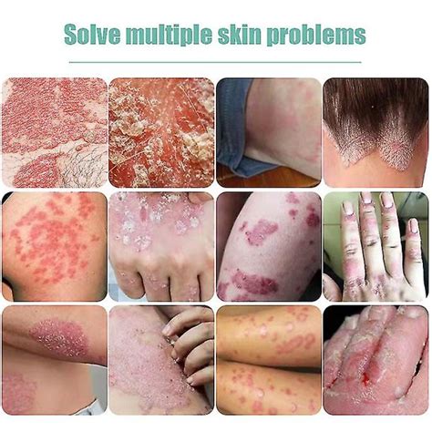 Crema Para La Piel Para La Psoriasis Pomada Para La Dermatitis