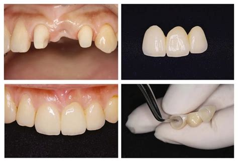 Missing Lateral Incisor Teeth