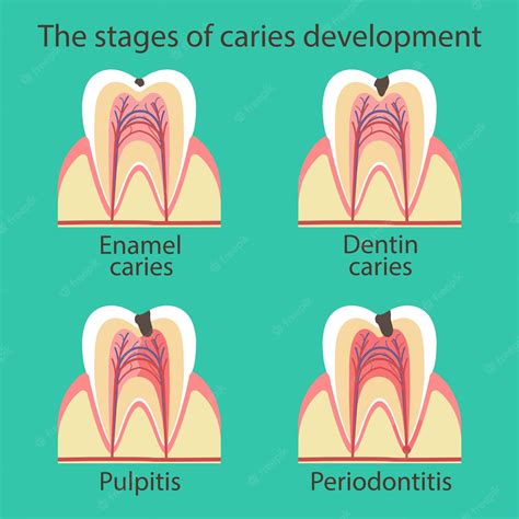 Premium Vector Development Of Dental Caries