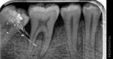 Regeneración periodontal regeneración tisular guiada