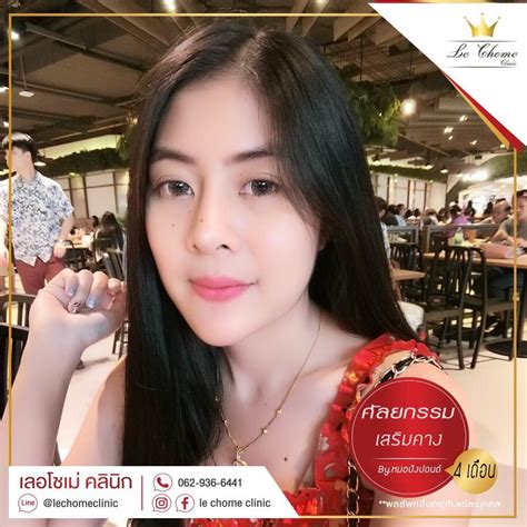 💋ปรับรูปหน้าให้เรียวสวย ด้วยคางทรงวี สวยเนียนเป็นธรรมชาติไร้รอยต่อแบบ