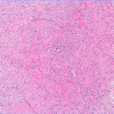 Histopathology Of The Resected Specimen Identified Tumor Cells On The