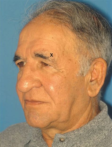 15 Endoscopic Forehead And Midface Lift Plastic Surgery Key