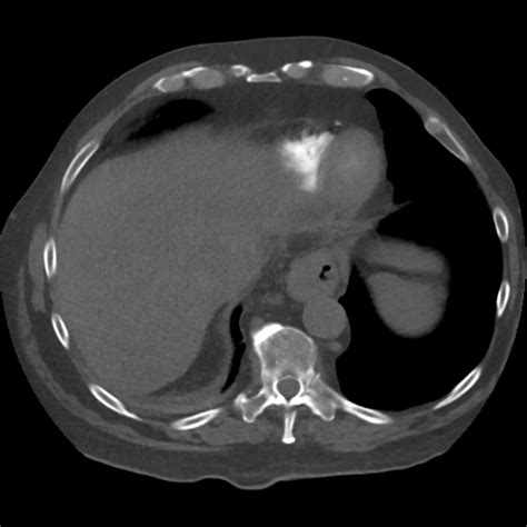 Filetumor Thrombus In Right Atrium Ivc And Right Renal Vein From