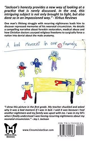 Circumcision Scar My Foreskin Restoration Neonatal Circumcision
