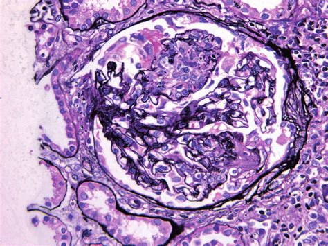 Representative Glomerulus From Case 2 There Is Segmental Endocapillary