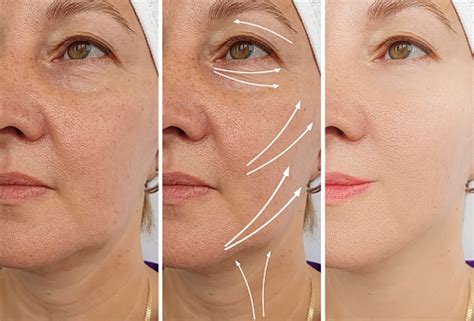 노인 은 치료 전후 눈을 주름 개념에 대한 스톡 사진 및 기타 이미지 개념 개념과 주제 개선 Istock