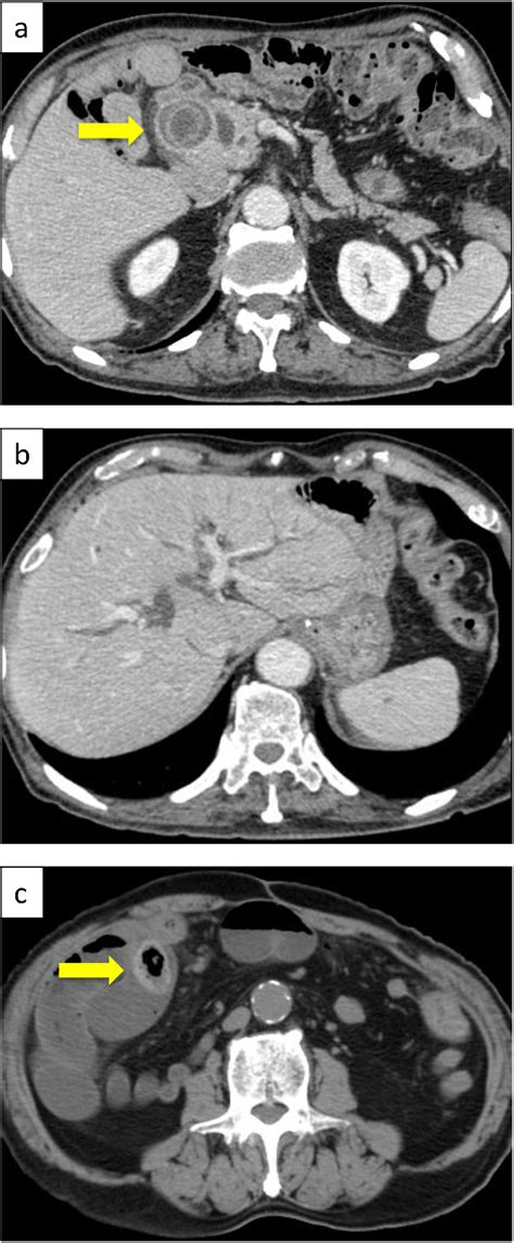 Figure 1 From Afferent Loop Obstruction With Obstructive Jaundice And Ileus Due To An Enterolith