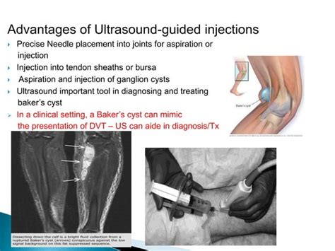 Joint Aspiration And Injection Techniques Powerpoint Pptx