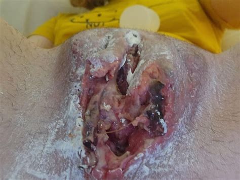 Mtf Bottom Surgery Its Been A Journey And Ive Still Got A Ways To Go