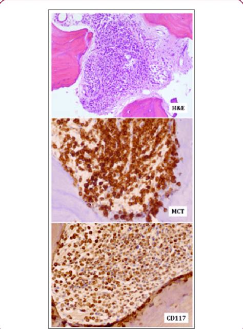 A Bone Marrow Infiltration By Neoplastic Mast Cells 10x Hematoxilin