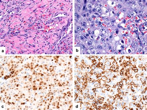 Soft Tissue Special Issue Cutaneous Pleomorphic Spindle Cell Tumors Pmc