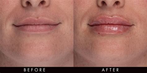 Lip Fillers And Injections Newcastle ~ Vamp Cosmetic Clinic