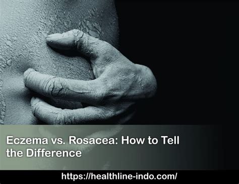 Eczema Vs Rosacea How To Tell The Difference Healthline Indonesia