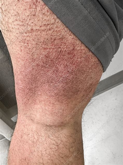 Mycosis Fungoides Stock Image C0602346 Science Photo Library