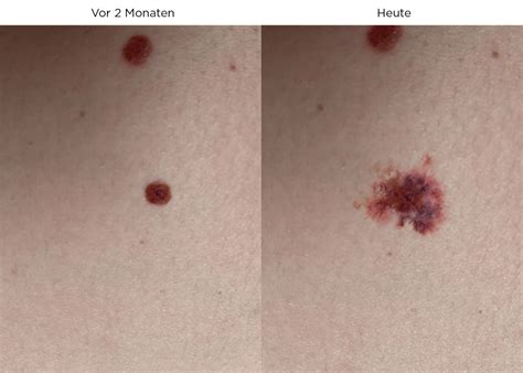 Stopp Melanom Quiz Msd Gesundheit Schweiz