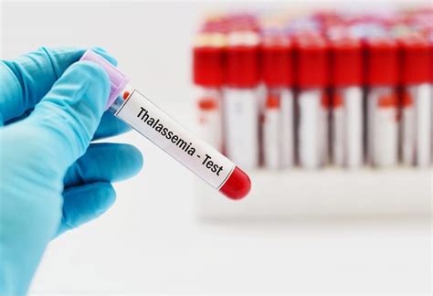 Thalassemia And Pregnancy Types Reasons And Treatment