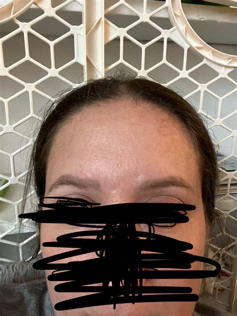 Quanta Discovery Pico Plus Rmicrobladingremoval