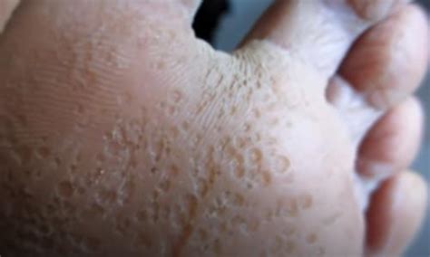 Pitted Keratolysis Treatment Symptoms And More