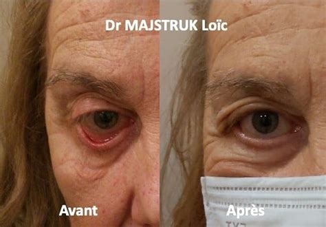 Anomalies des paupières liées à l âge OphtaProvence Aix en Provence