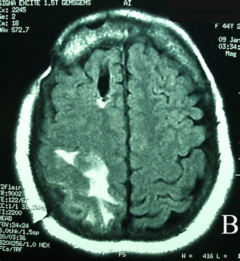 A Brain Mri Showed A Right Heterogeneous Frontoparietal Lesion On The