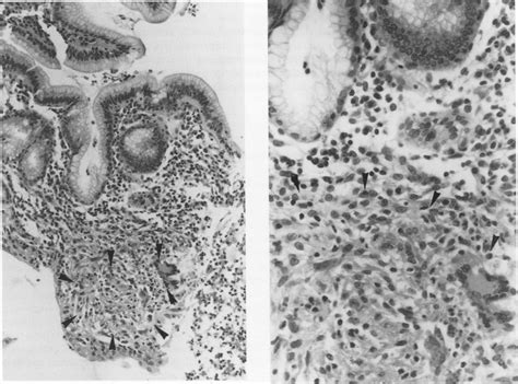 A Gastric Biopsy Specimen Before Treatment Sarcoid Like Granuloma