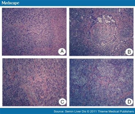 Intrahepatic Cholangiocarcinoma New Insights In Pathology Page 5