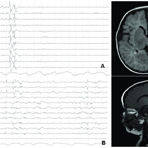 Grading Of Thompson Score At Day 1 2 3 N 84 Download Scientific Diagram