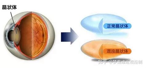 全球第一的致盲性眼病 白内障快追上你了 还不快来庇护所 知乎