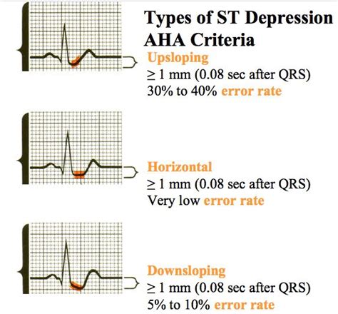 Medical Addicts Types Of St Depression On Ecg