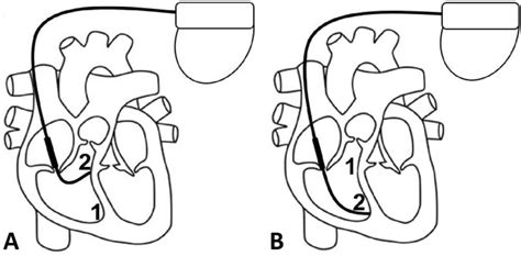The Scheme Of Defibrillation Lead Implantation Technique In The 1st