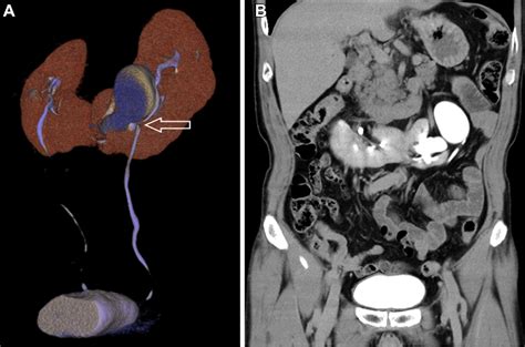 Figure 1 From Laparoscopic Pyeloplasty For Ureteropelvic Junction