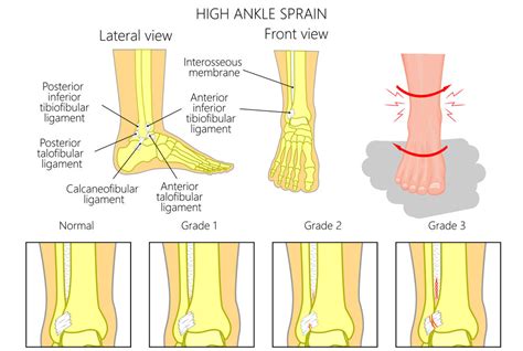 Understanding And Managing High Ankle Sprains Gatsbyshoes