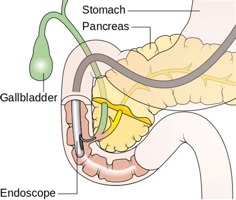Endoscopic Retrograde Cholangiopancreatography Ercp The Oregon Clinic