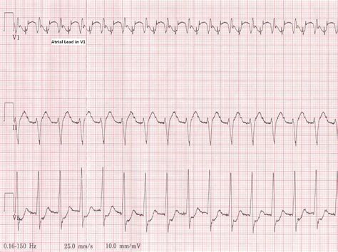 Pedi Cardiology Ekg Quiz