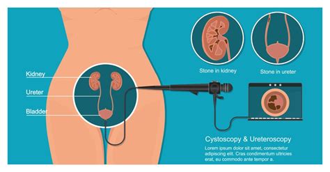 Urinary Catheter Is A Flexible Tube Used To Empty Vector Image