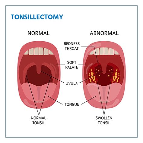 Tonsillectomy Anatomy