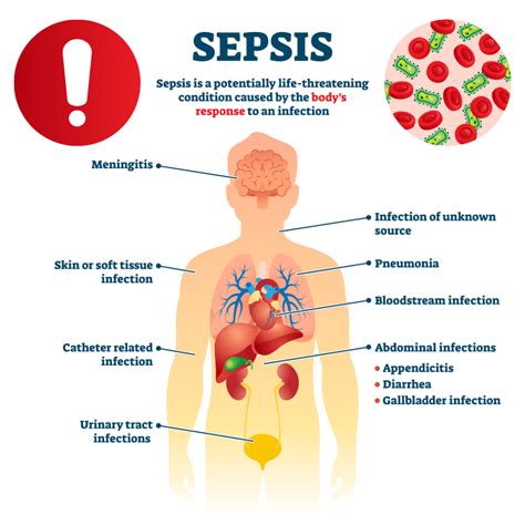 Sepsis Infection Cdc Puts Spotlight On Sepsis As Medical
