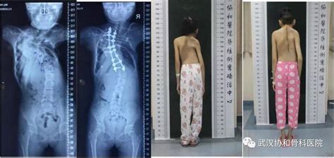 敢为人先，勇立潮头 ——协和骨科杨操教授团队挑战重度脊柱侧弯手术禁区 搜狐大视野 搜狐新闻