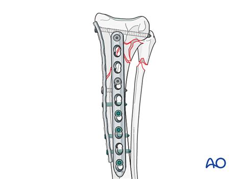 Bridging Plate And Screw Fixation For Multifragmentary Extraarticular Fracture