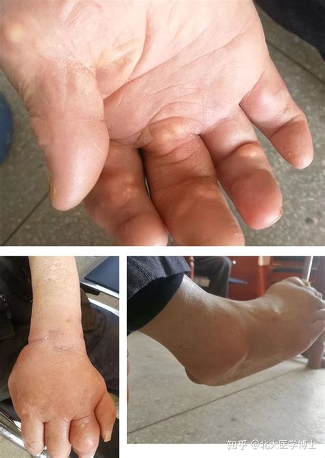 痛风想断根，其实也简单，陈皮这么搭配用，尿酸自己降 知乎