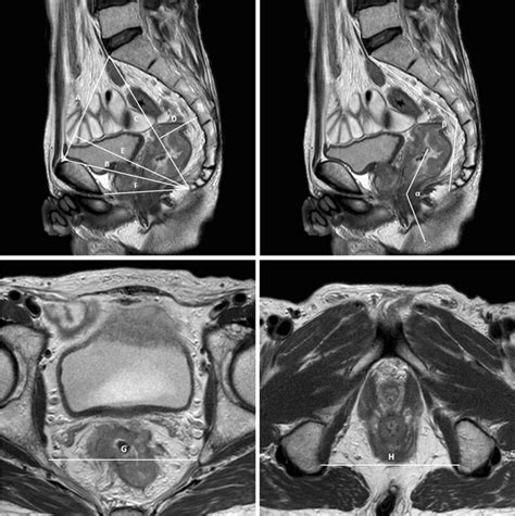 Mri Based Pelvimetry A Pelvic Inlet B Pubococcygeal Distance C
