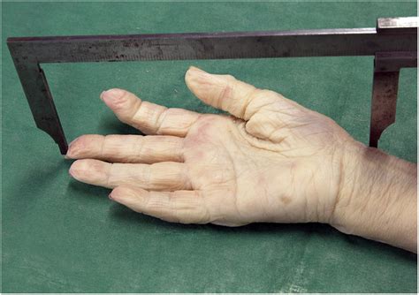 Measurement Of Hand Length In Mm With A Sliding Caliper The Stylion