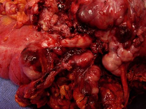 Colon Neoplasm Gist 2136 Colon Gist Invading Abdominal Wall And Bladder